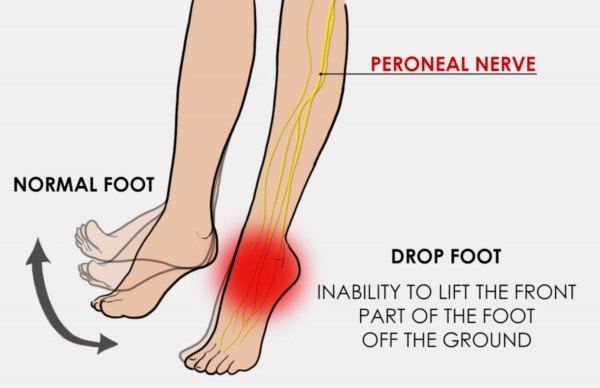Muscle Twitching Fear: Foot Drop Strength Test Guidelines » Scary Symptoms