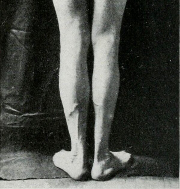 ALS Muscle Atrophy vs. Benign Atrophy: the Difference » Scary Symptoms