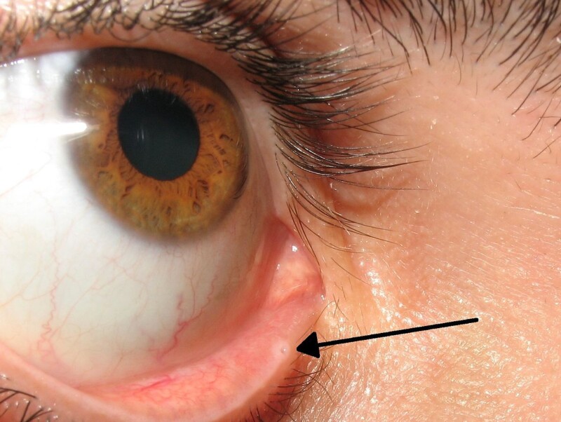 Sudden-Onset One-Eye Epiphora: Possible Causes » Scary Symptoms