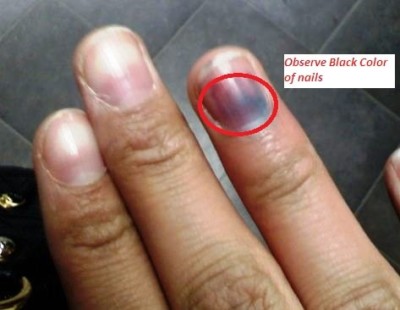 Is Nail Melanoma Always a Stripe or Can It Be a Smudge? » Scary Symptoms