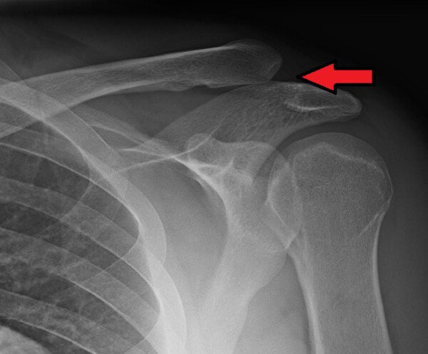 Can an X-ray Miss a Grade 1 AC injury? » Scary Symptoms