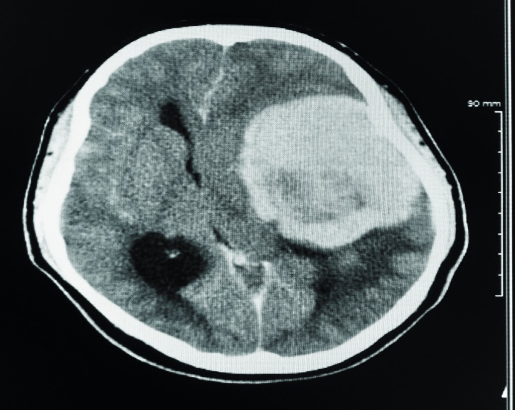 Can A CT Scan Detect A Brain Tumor Scary Symptoms Can A CT Scan Detect A Brain Tumor Scary Symptoms