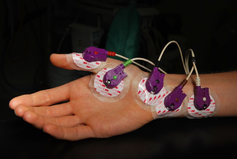 How Often Is ALS Misdiagnosed As Benign Fasciculation Syndrome? » Scary ...