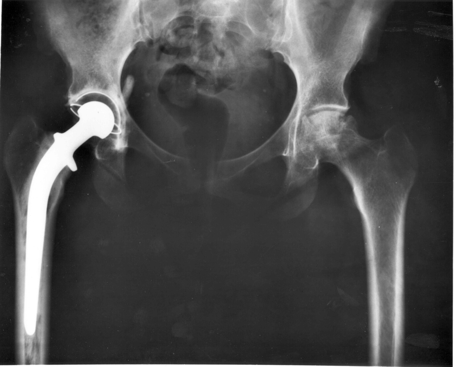 How Safe Are Hip & Knee Replacements for People Over 80? » Scary Symptoms