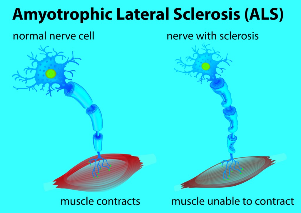 ALS Weakness vs. BFS Weakness: Comparison of Symptoms » Scary Symptoms