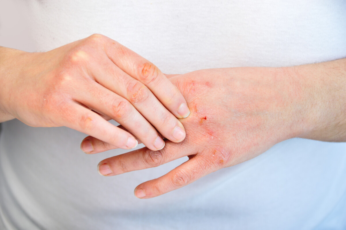Best Solutions for Dry, Cracked Winter Knuckles that Bleed » Scary Symptoms