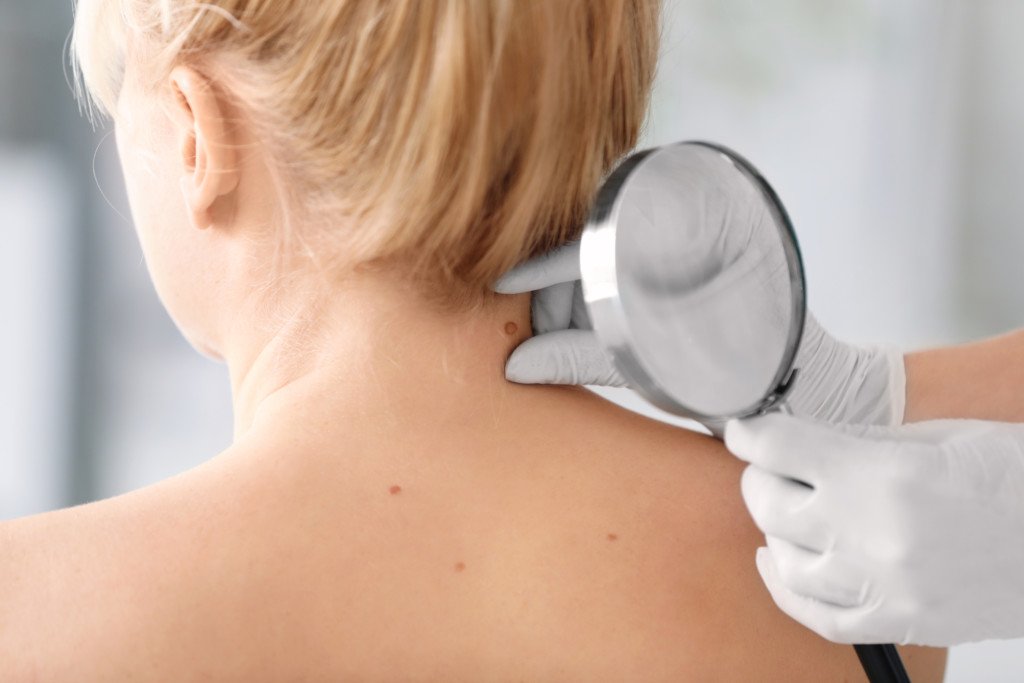 Can Normal Mole Hurt If Irritated Or Does Hurting Mean Cancer Scary