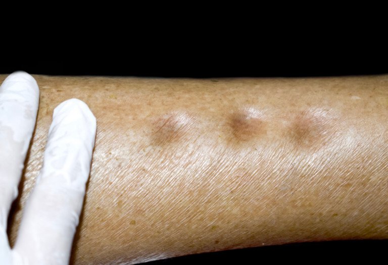 When Those Scary Sock Indentations Don't Mean Edema » Scary Symptoms