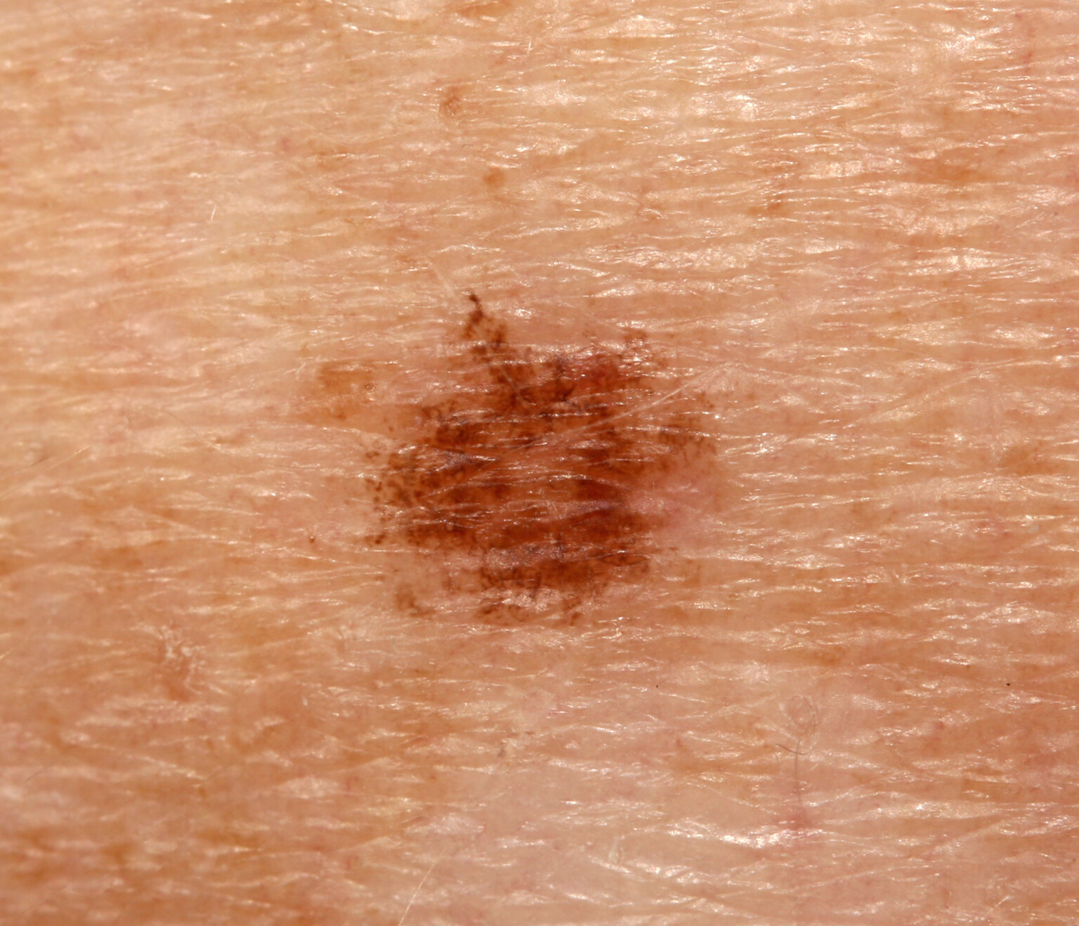 When Brown Mole Turns Red: Melanoma or Nothing to Worry About? » Scary ...