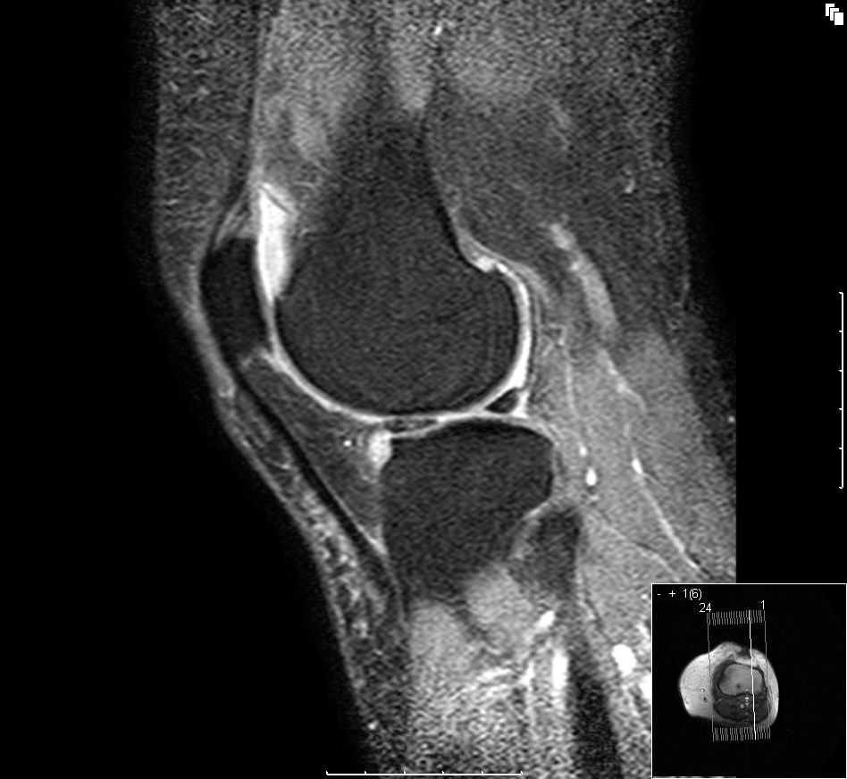 Relief of Osteoarthritis Knee Pain without Drugs, Surgery » Scary Symptoms