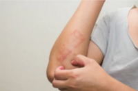 Causes of Itchy Bumps on Elbows and What to Do About This » Scary Symptoms