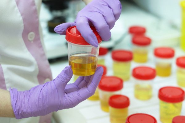 Causes of White Specks or Particles in Urine: See a Doctor » Scary Symptoms