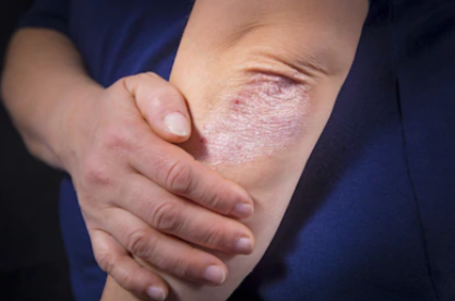 Causes of Itchy Bumps on Elbows and What to Do About This » Scary Symptoms