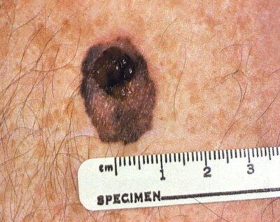 What Does Early Detection Mean for Melanoma? » Scary Symptoms