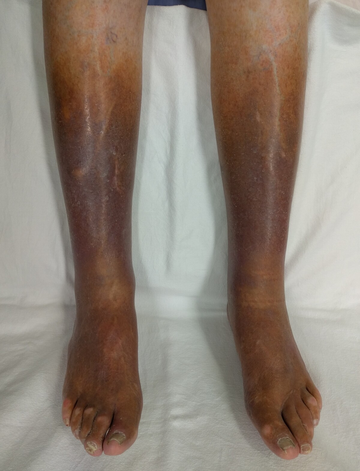 The Two Leading Causes of Chronic Venous Insufficiency? » Scary Symptoms