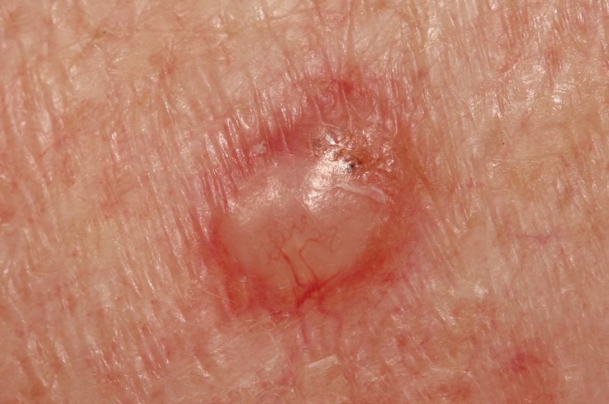 Hard Pimple that Won't Go Away After 2 Months May Be Cancer » Scary ...