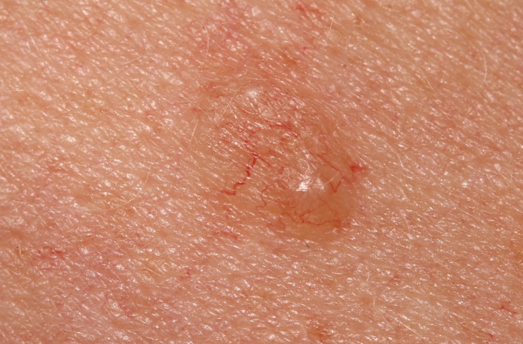 Why Does Basal Cell Carcinoma Affect the Nose so Much? » Scary Symptoms