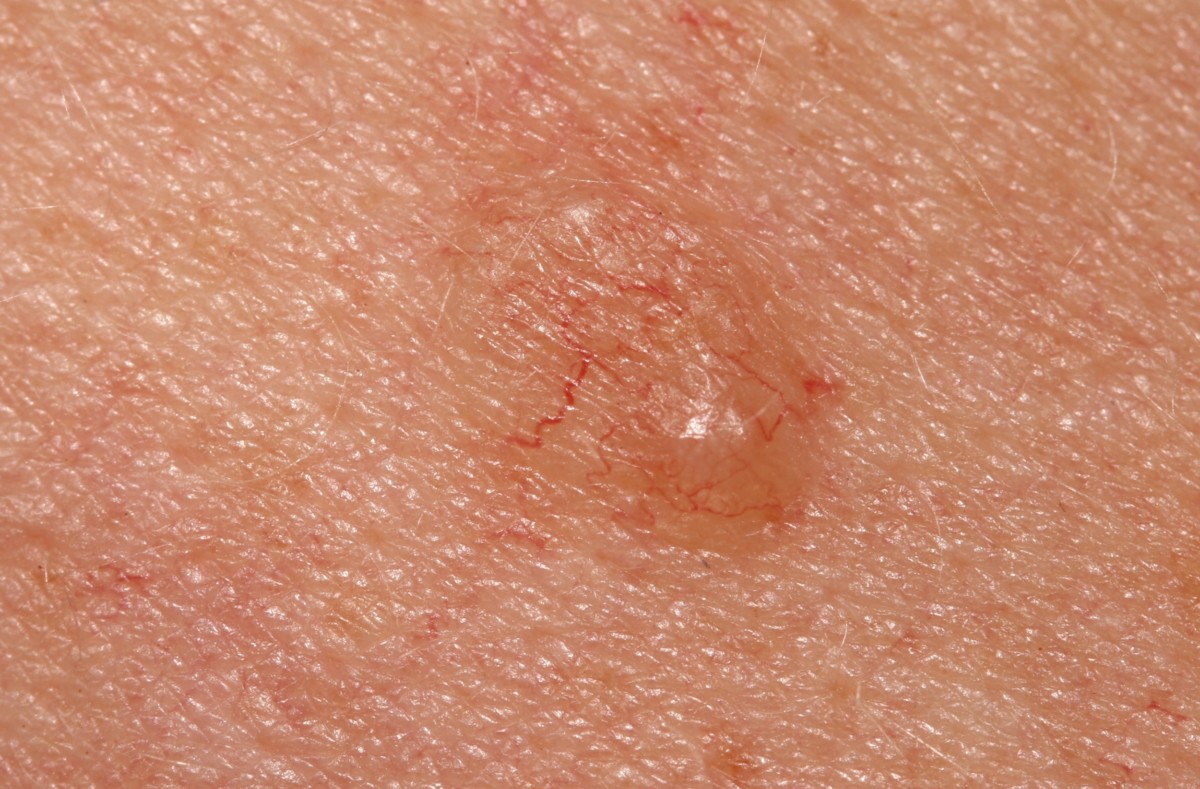 When Cancer Can Mimic an Earlobe Pimple: Know the Signs » Scary Symptoms