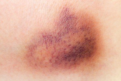 Can Breast Cancer Cause a Bruise-Like Area on the Skin? » Scary Symptoms