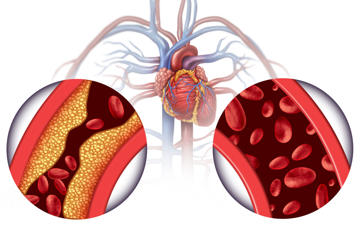 Natural Ways to Unclog Coronary Artery Soft Plaque » Scary Symptoms