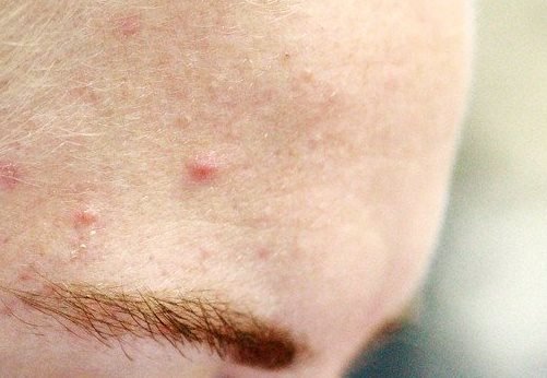Hard Pimple that Won't Go Away After 2 Months May Be Cancer » Scary ...