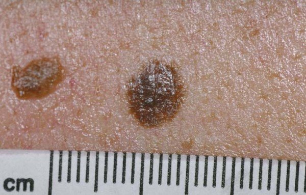 You Know You Should Get that Suspicious Mole Checked When… » Scary Symptoms