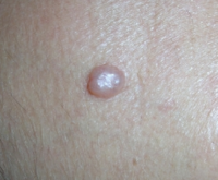 Hard Pimple that Won't Go Away After 2 Months May Be Cancer » Scary ...