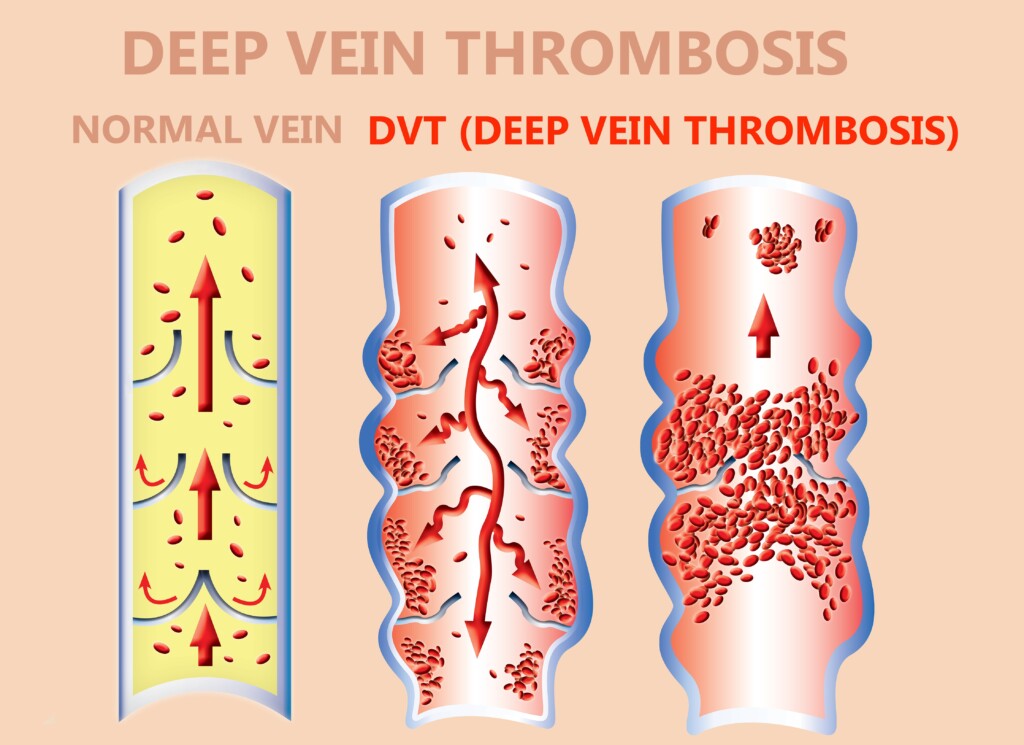 Does Psoriatic Arthritis Increase DVT Risk? » Scary Symptoms