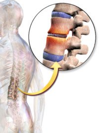 Extruded or Herniated Disc: Long Term Effects » Scary Symptoms