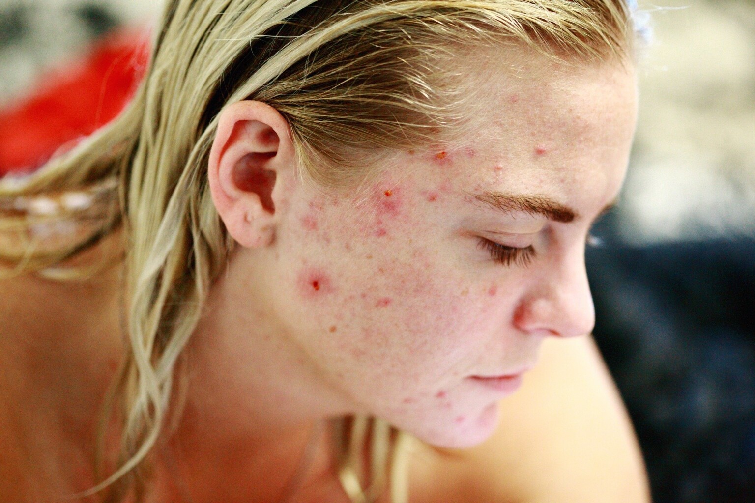 What Causes Acne to Be Worse on One Side of the Face? » Scary Symptoms