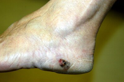Can Two Moles in Different Areas Be Melanoma at Once? » Scary Symptoms
