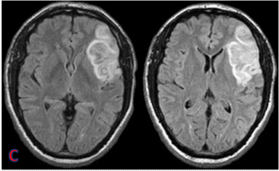 Can an MRI Miss a Stroke? MRI vs. CT Scan for Stroke Detection » Scary ...