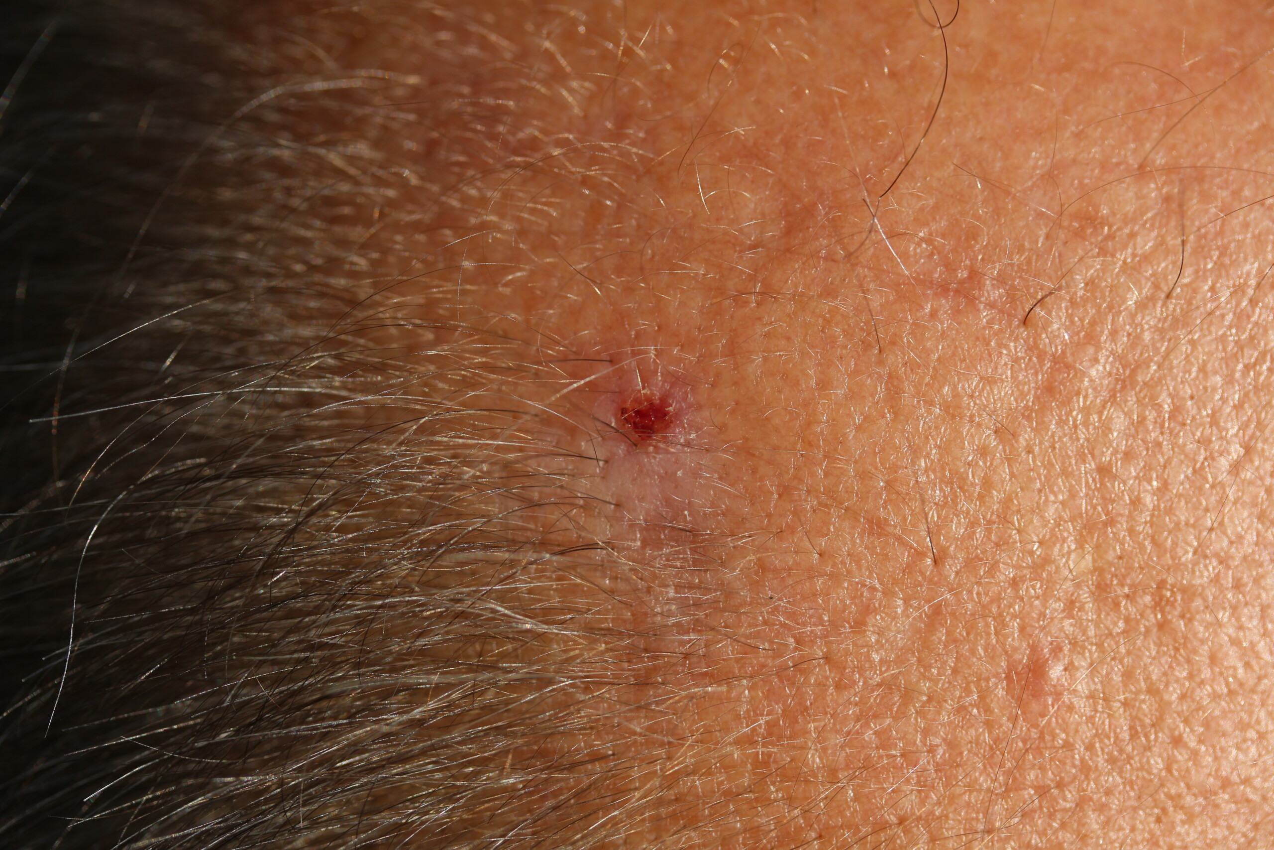 Panicking Over a Diagnosis of Actinic Keratosis? » Scary Symptoms