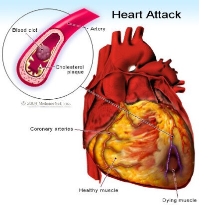 How a Heart Attack Occurs without Blocked Arteries » Scary Symptoms