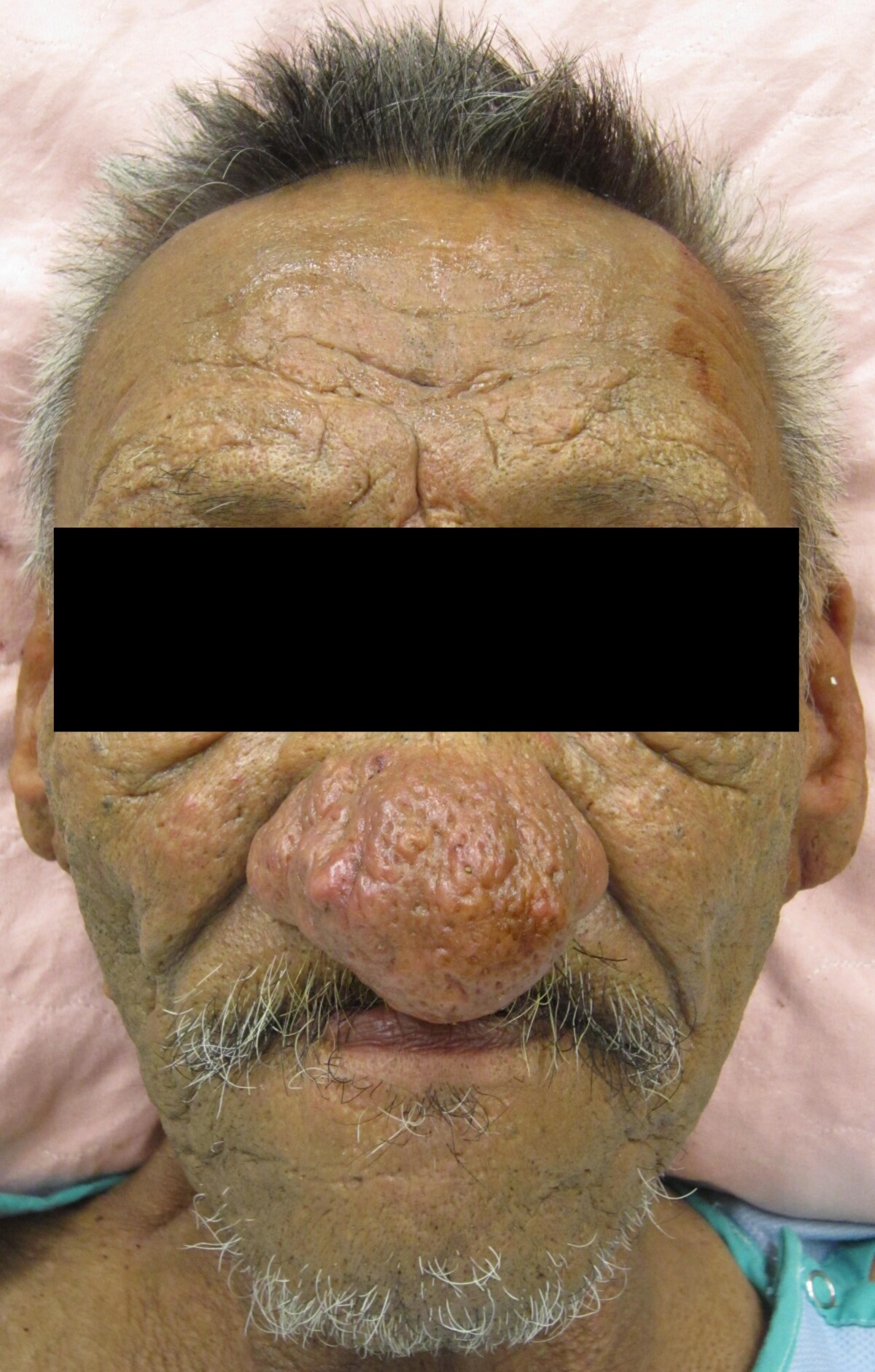 What is Rhinophyma and Its Link to Skin Cancer » Scary Symptoms