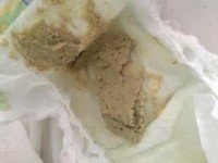 Causes of Grey Green Stools in a Baby: Grey Is Cause for Alarm » Scary ...