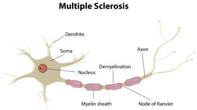 Benign Muscle Twitching vs. MS Twitching: the Differences » Scary Symptoms