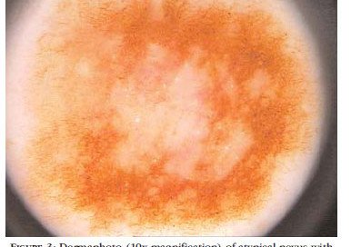 ATYPICAL OR PRECANCEROUS MOLES Archives » Scary Symptoms