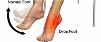 18 Causes of Foot Drop Including Benign and Serious like ALS » Scary ...