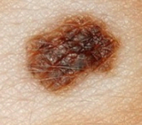 Can a Mole with Three Shades Be Benign? » Scary Symptoms