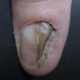 Warning Signs a Nail Melanoma Was Misdiagnosed As Benign » Scary Symptoms