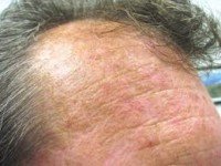 Flaky Dry Patches on Forehead: Causes, Solutions » Scary Symptoms