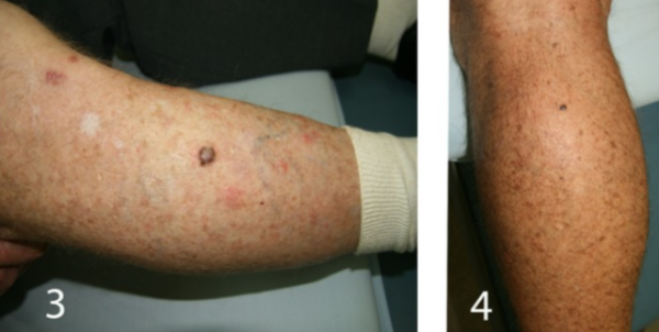 Nodular Melanoma: What You Should Know About this Killer » Scary Symptoms