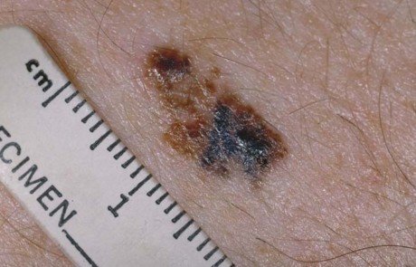 What Colors Can Melanoma Skin Cancer Be? » Scary Symptoms