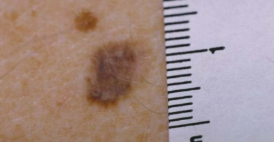 What Colors Can Melanoma Skin Cancer Be? » Scary Symptoms