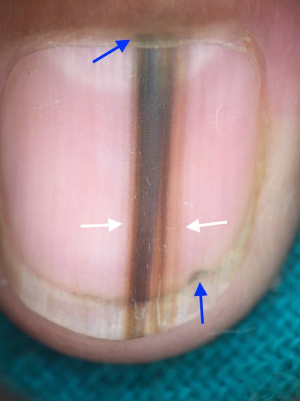 Longitudinal Melanonychia vs. Subungual Melanoma » Scary Symptoms