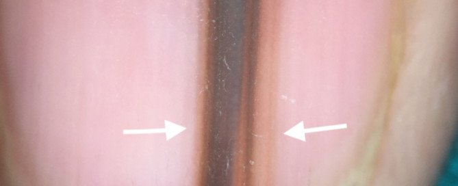 APPEARANCE OF MELANOMA Archives » Scary Symptoms