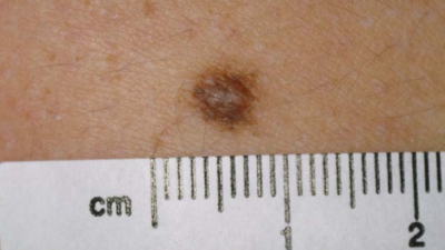 Tiny Mole Growing Larger but Still Looks Normal: Self-Exams » Scary ...