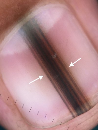 Longitudinal Melanonychia vs. Subungual Melanoma » Scary Symptoms