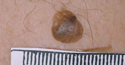 What Does a Grey and Yellow Mole Mean ? Should You Worry ? » Scary Symptoms